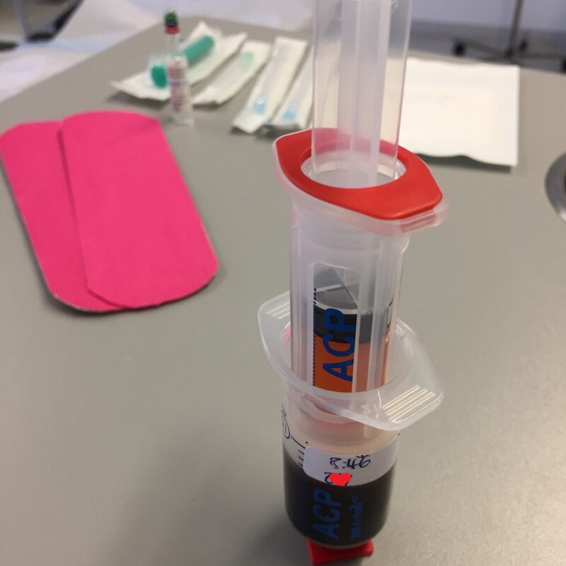 ACP-Therapie | Behandlung von Arthrose und Sportverletzungen