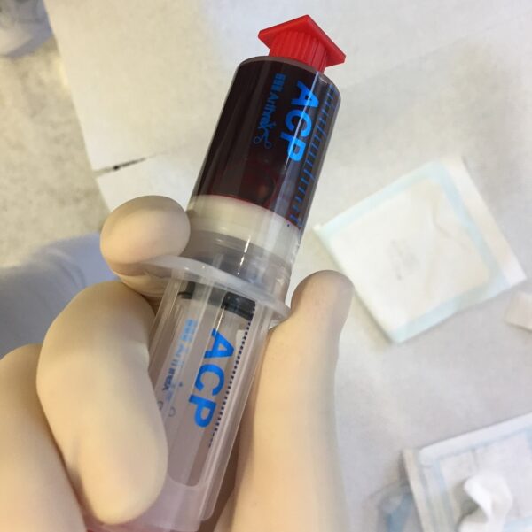 ACP-Therapie | Behandlung von Arthrose und Sportverletzungen