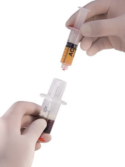 ACP-Therapie | Behandlung von Arthrose und Sportverletzungen