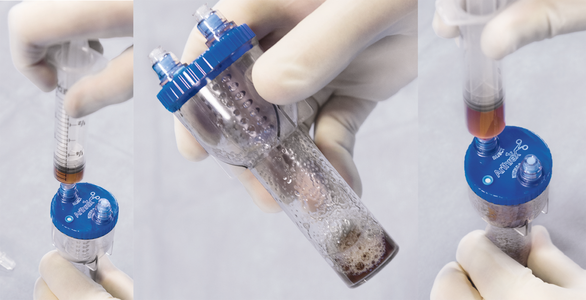 AutoCart™ Therapie zur Transplantation von körpereigenem Knorpel