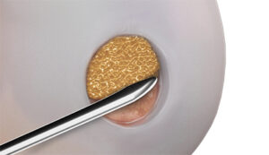 AutoCart™ Therapie zur Transplantation von körpereigenem Knorpel