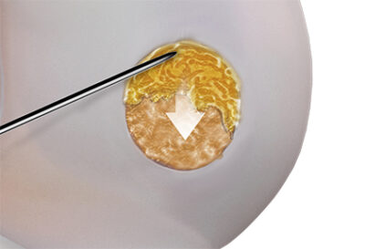 AutoCart™ Therapie zur Transplantation von körpereigenem Knorpel