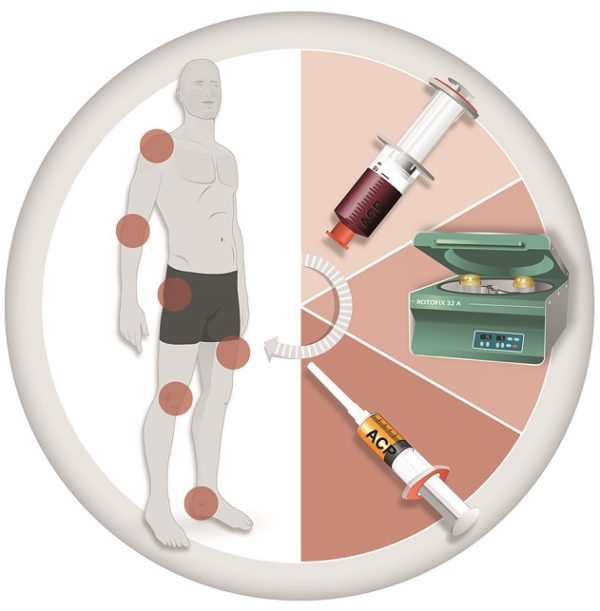 Acp Therapie Nebenwirkungen